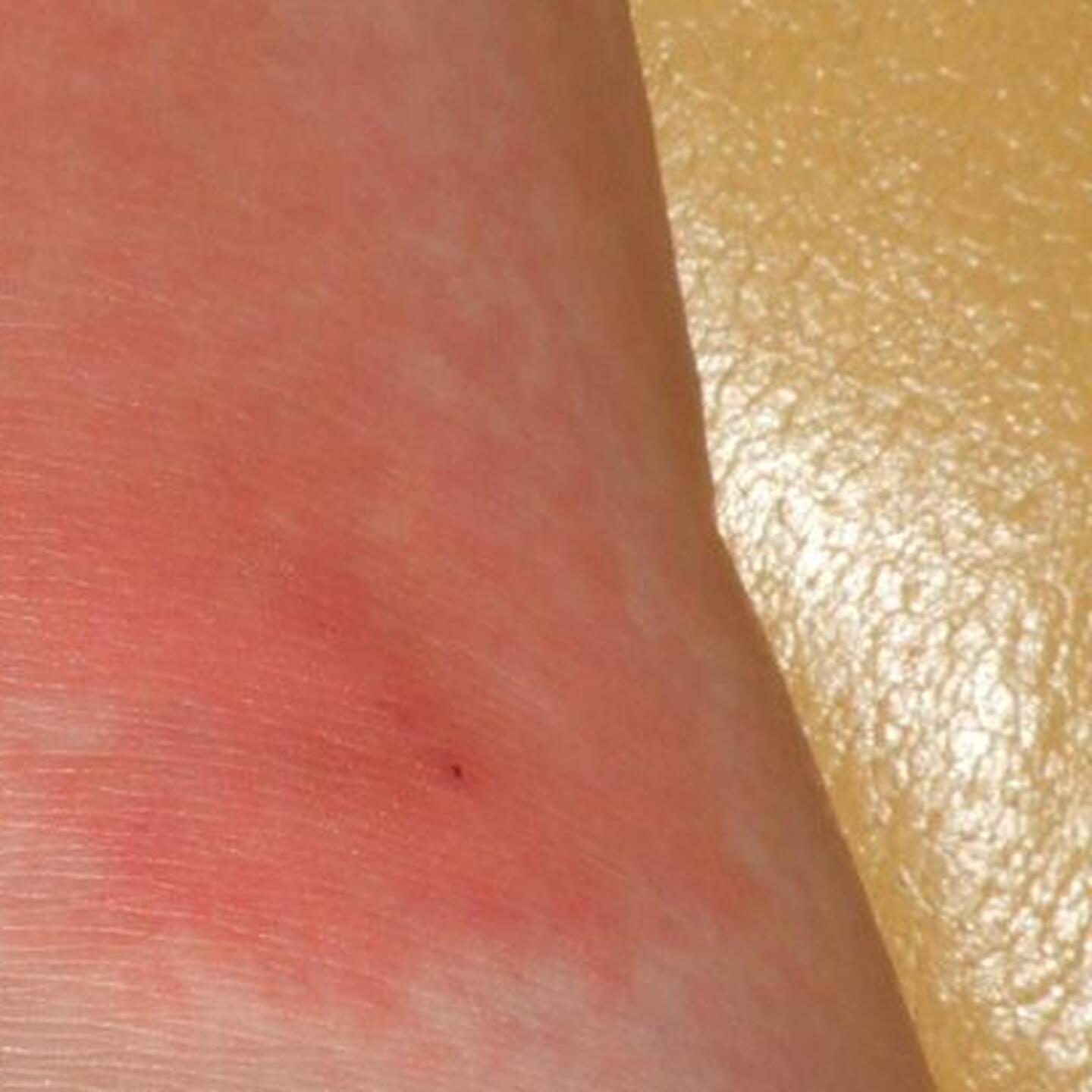 Erysipel (Wundrose) – Ursachen, Symptome & Therapie | Lymphnetzwerk