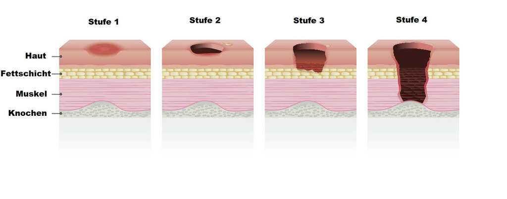 Dekubitus - Lymphnetzwerk