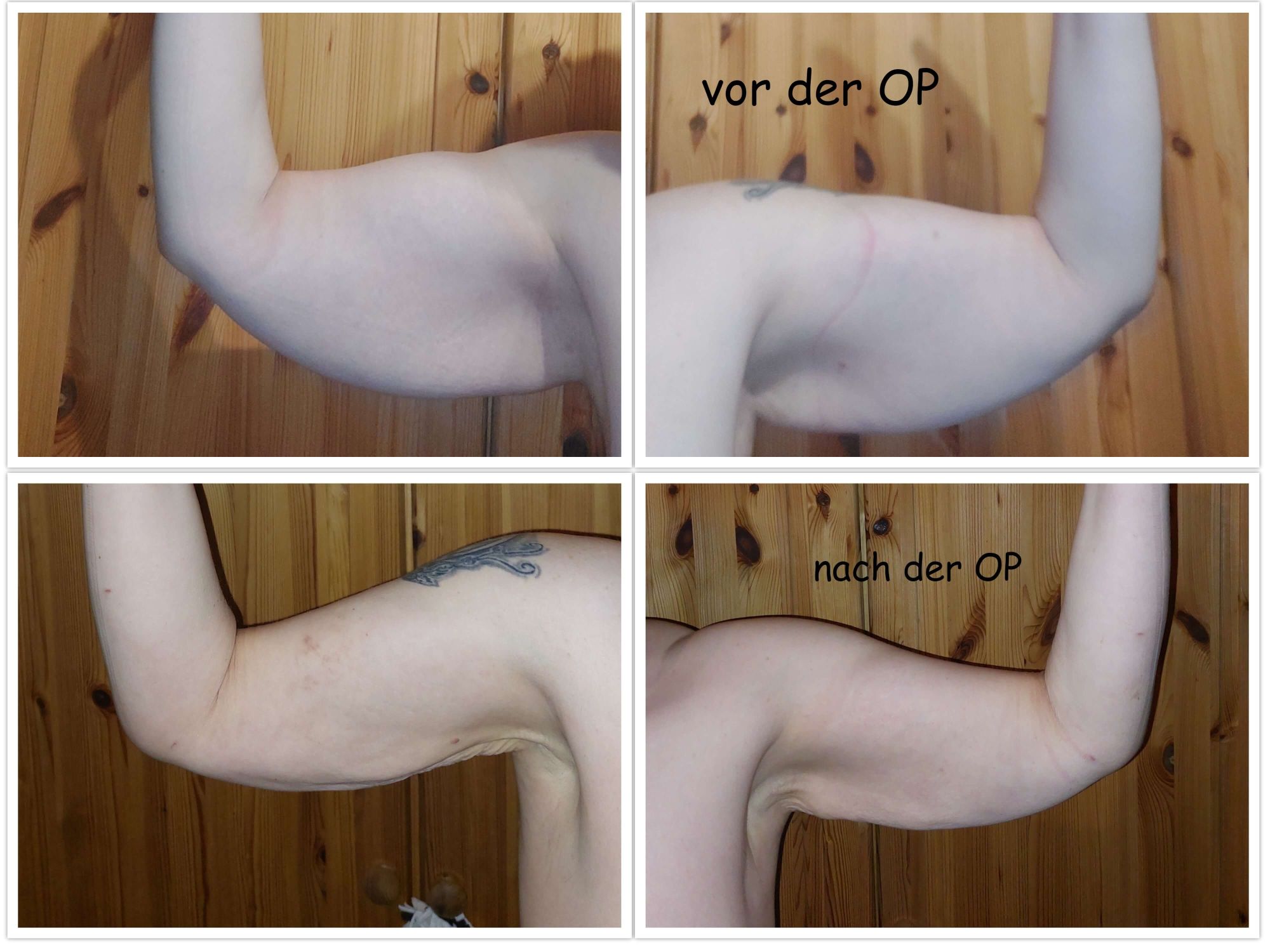 Lymphdrainage Arme Vorher Nachher