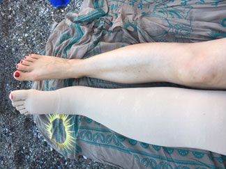 Tanja F. Lymphödem Erfahrungen und Therapieansätze ein besseres Leben ...